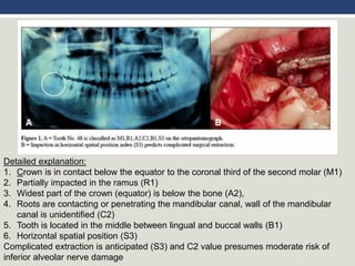 Teeth impaction | PPTX | Dental Health | Diseases and Conditions