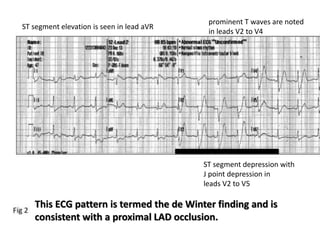 Presentation the electrocardiogram in the acs patient | PPTX