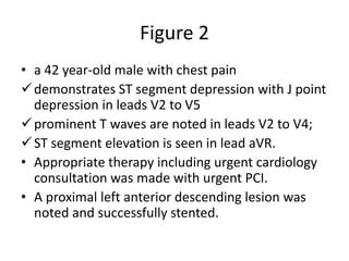 Presentation the electrocardiogram in the acs patient | PPTX