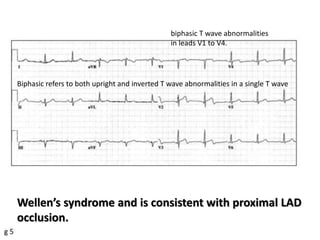 Presentation the electrocardiogram in the acs patient | PPTX