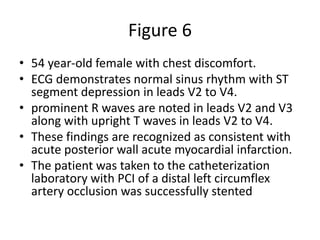 Presentation the electrocardiogram in the acs patient | PPT