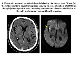 transient ischemic attacks- advances in diagnosis & mx | PPTX