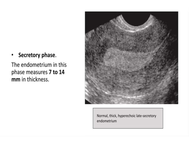ANATOMY OF FEMALE REPRODUCTIVE TRACT ON USG | PPTX
