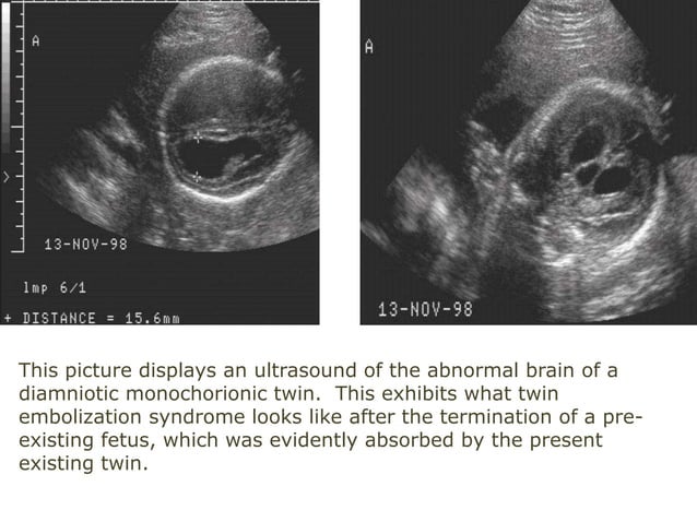 bio wiki: Twin Absorption | PPTX