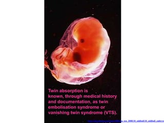 bio wiki: Twin Absorption | PPTX