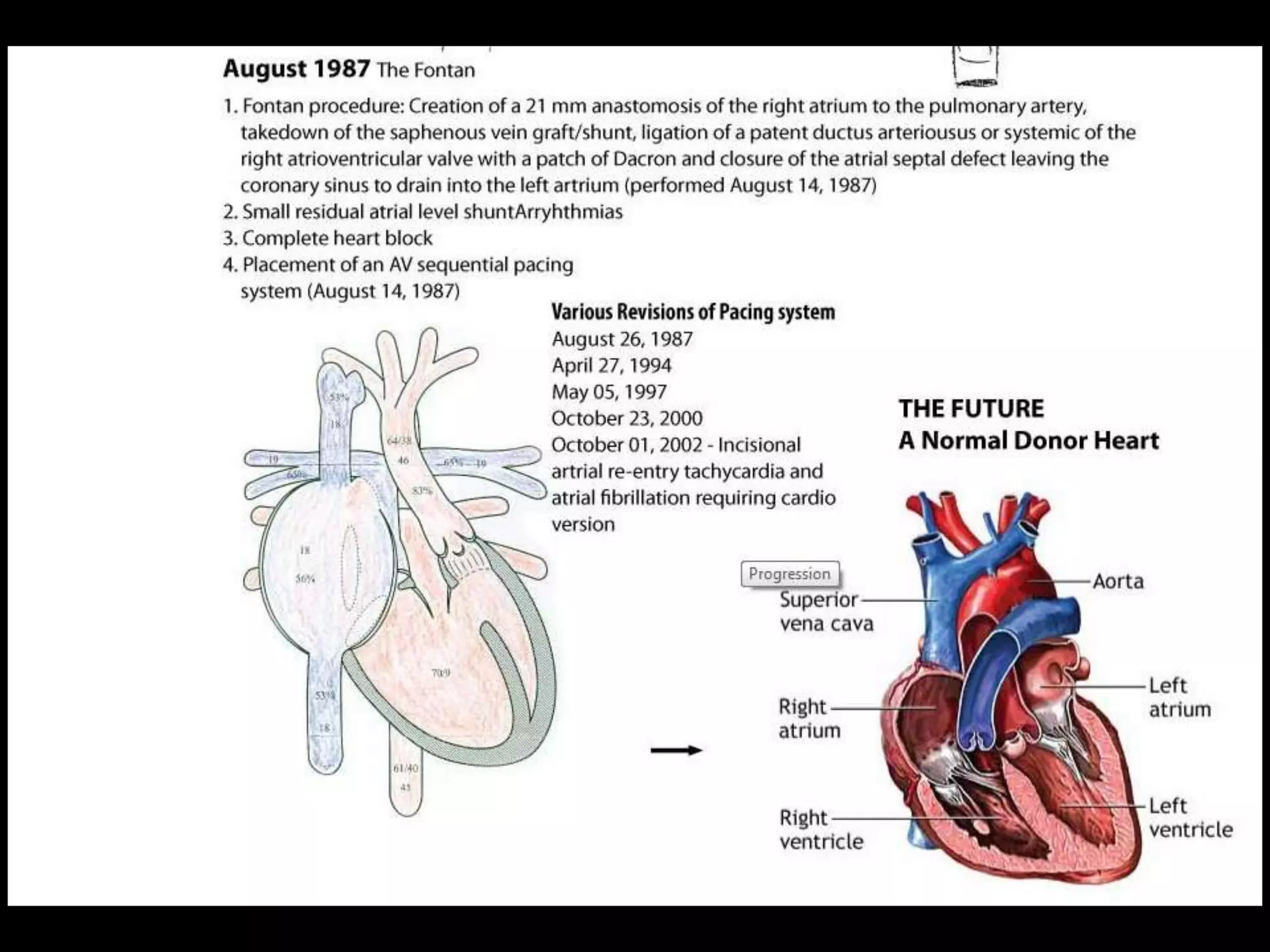 Exploring Congenital Heart Defects: Tricsupid Atresia | PPTX
