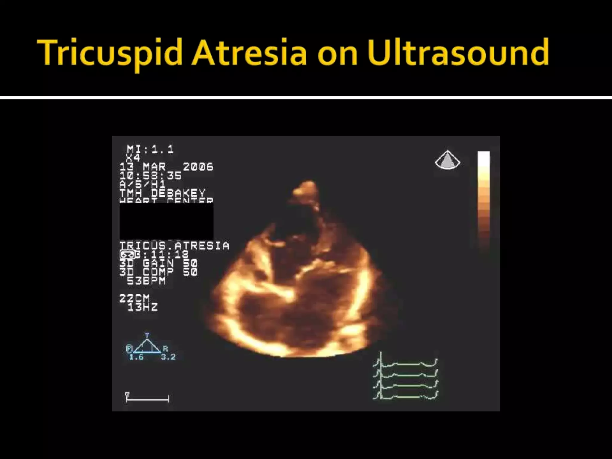 Exploring Congenital Heart Defects: Tricsupid Atresia | PPTX