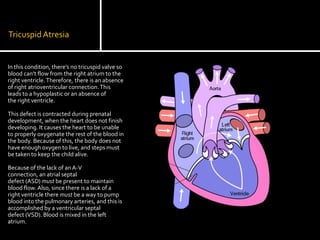 Exploring Congenital Heart Defects: Tricsupid Atresia | PPTX