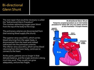 Exploring Congenital Heart Defects: Tricsupid Atresia | PPTX