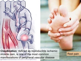 Peripheral arterial occlusive disease | PPT