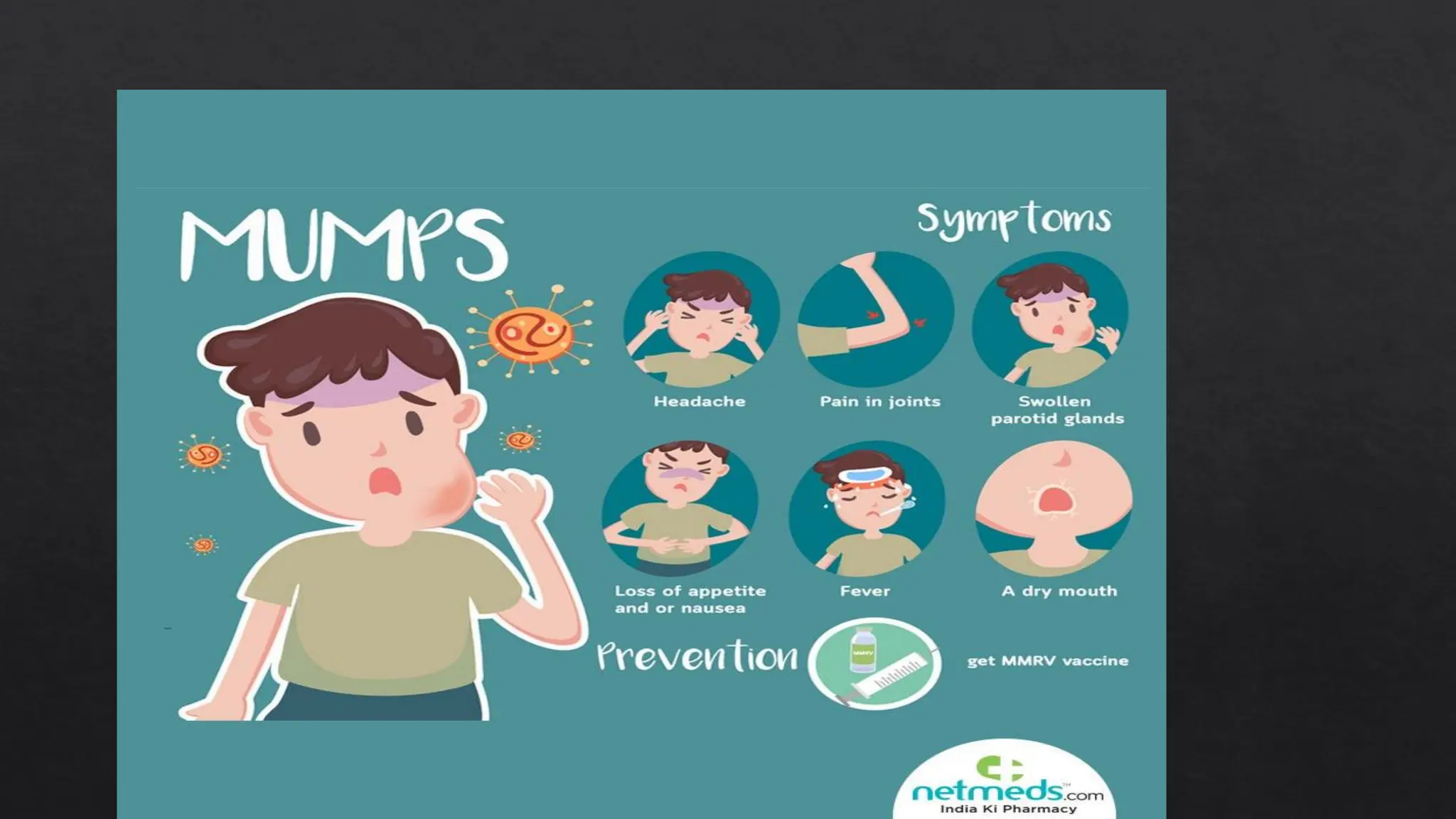 Parotitis or Mumps ppt for 3rd semesters | PDF