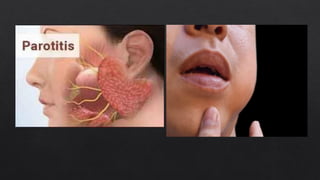 Parotitis or Mumps ppt for 3rd semesters | PDF