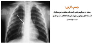 CXR - Simple But Important | PPT