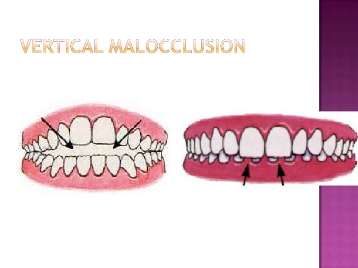 Vertical Malocclusion