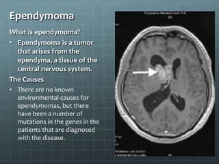 Brain Tumor | PPTX