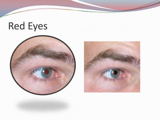 Red Eye & Smart Erase | PPTX