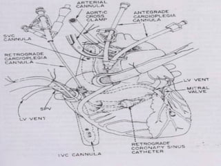 principles of cardiopulmonary bypass | PPT