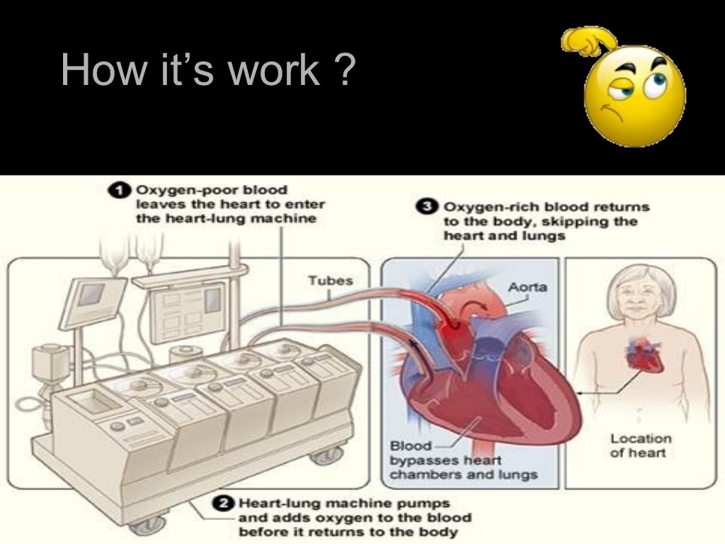 principles of cardiopulmonary bypass