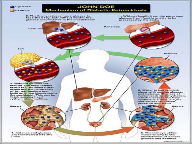 Diabetic Ketoacidosis