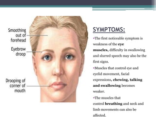 myasthenia gravis | PPTX