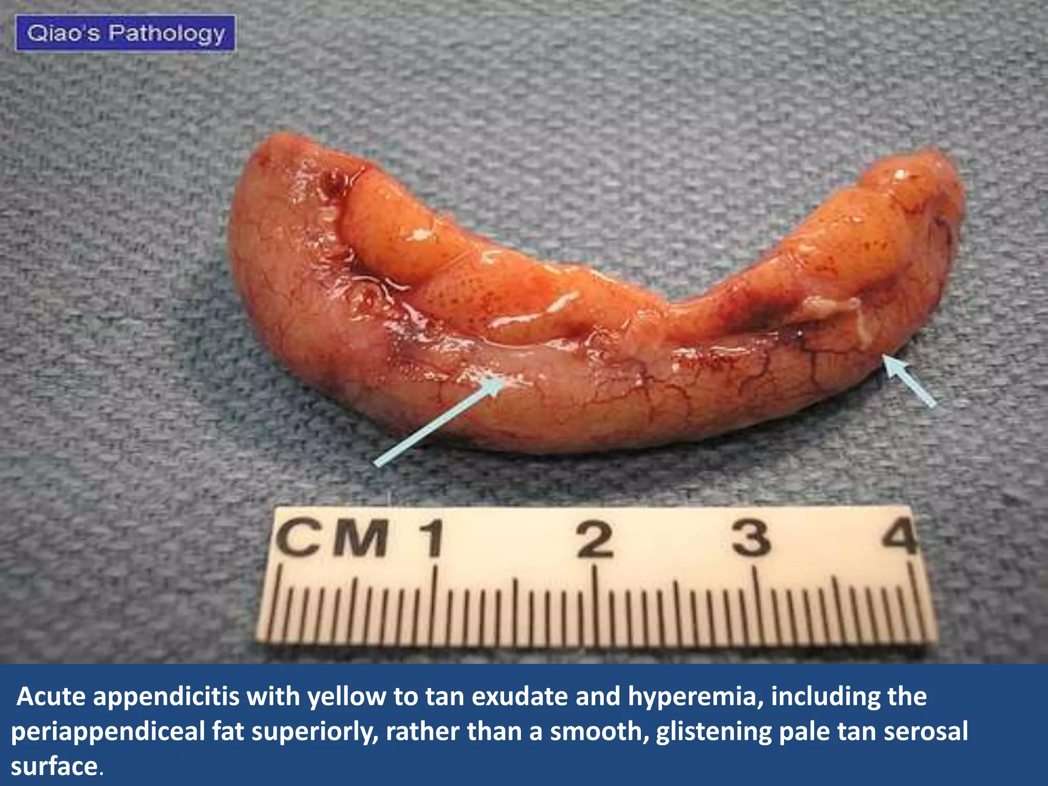 appendix gross | PPTX