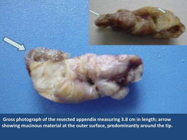 appendix gross | PPT