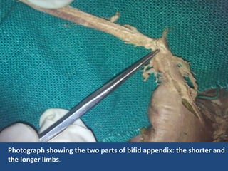 appendix gross | PPT