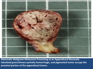 appendix gross | PPT