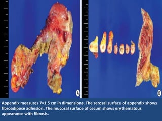 appendix gross | PPT