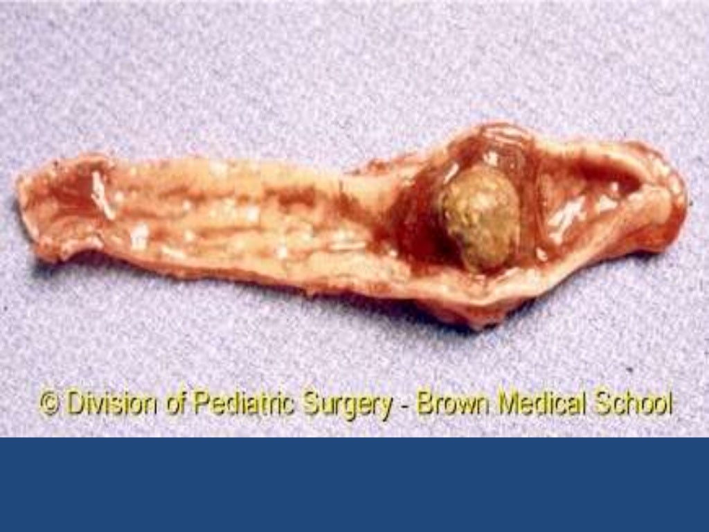 appendix gross