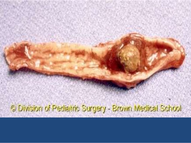 appendix gross