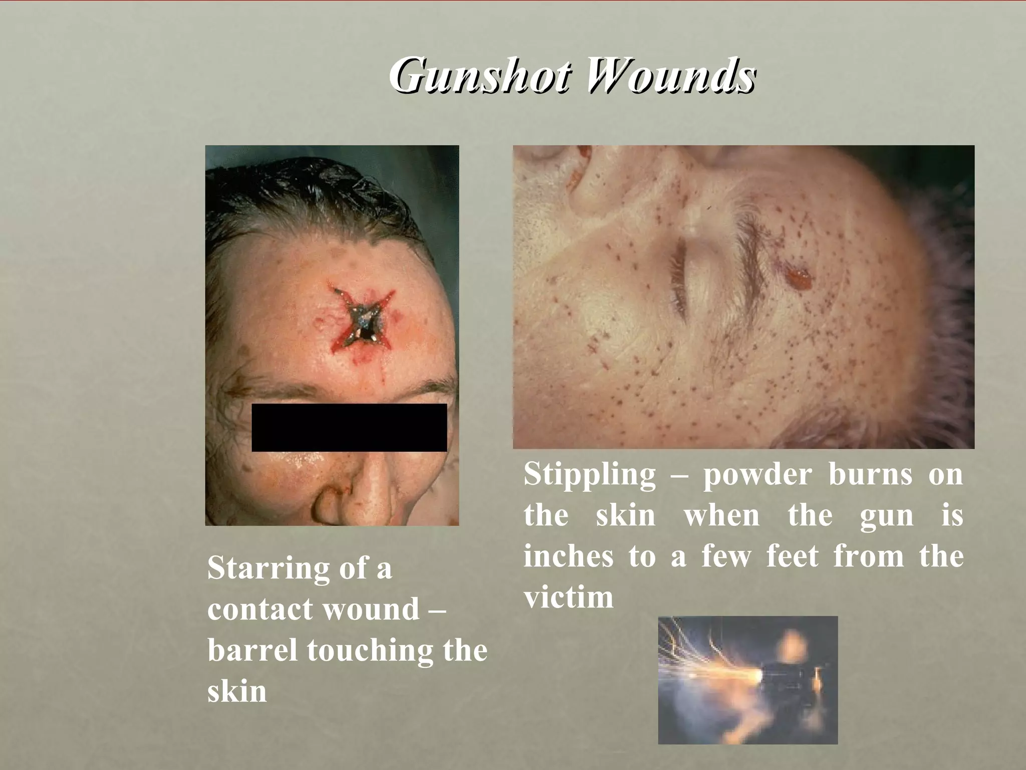 Wounds in forensic medicine | PPT