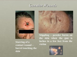Wounds in forensic medicine | PPT