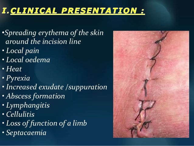 SURGICAL SITE INFECTION (SSI)