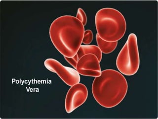 Polycythemia Rubra Vera | PPTX