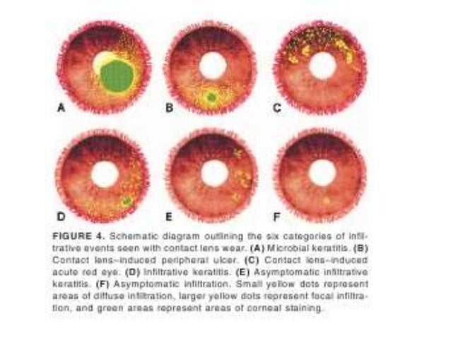 Contact Lens-Induced Acute Red Eye(CLARE)