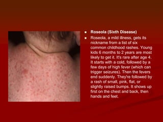 evaluating a child with febrile rash | PPTX