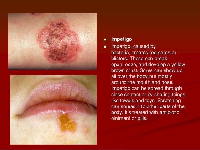 evaluating a child with febrile rash