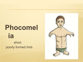 Presentation1.pptx limbs | PPTX