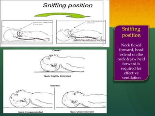The Premature Infant & Anaesthesia | PPTX