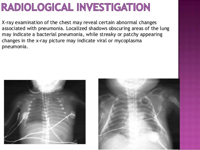 congenital pneumonia