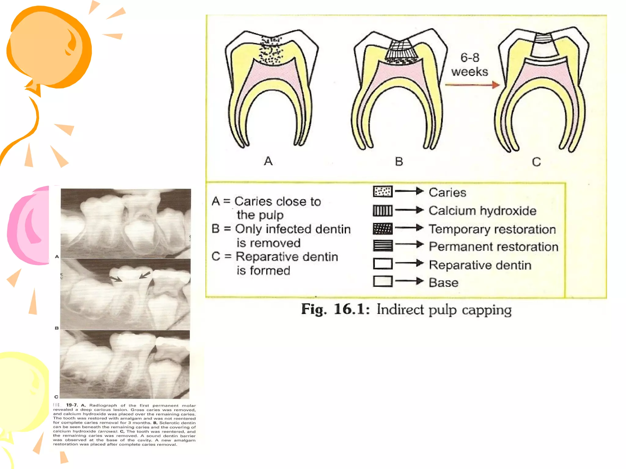 pulp therapy in pediatric dentistry | PPT