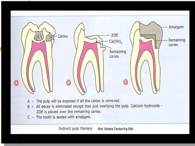 pulp therapy in pediatric dentistry | PPT