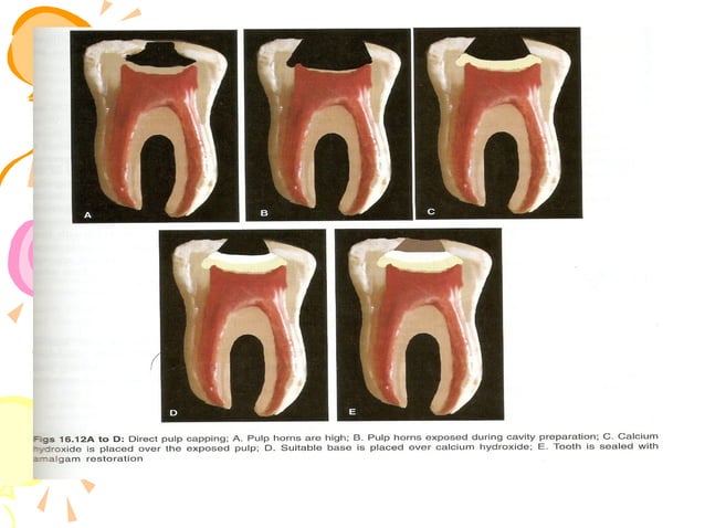 pulp therapy in pediatric dentistry | PPT