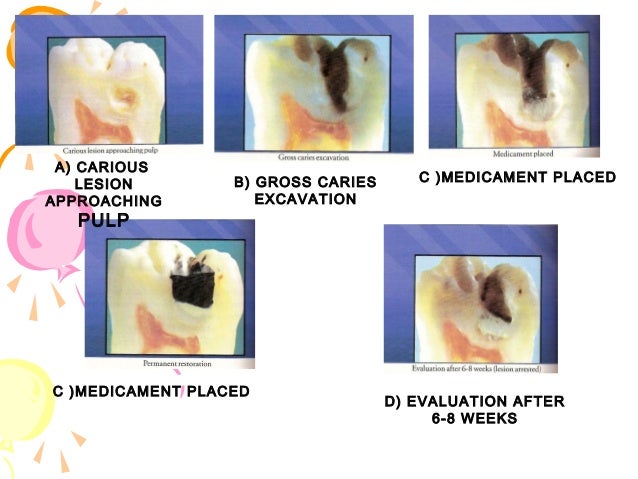 pulp therapy in pediatric dentistry