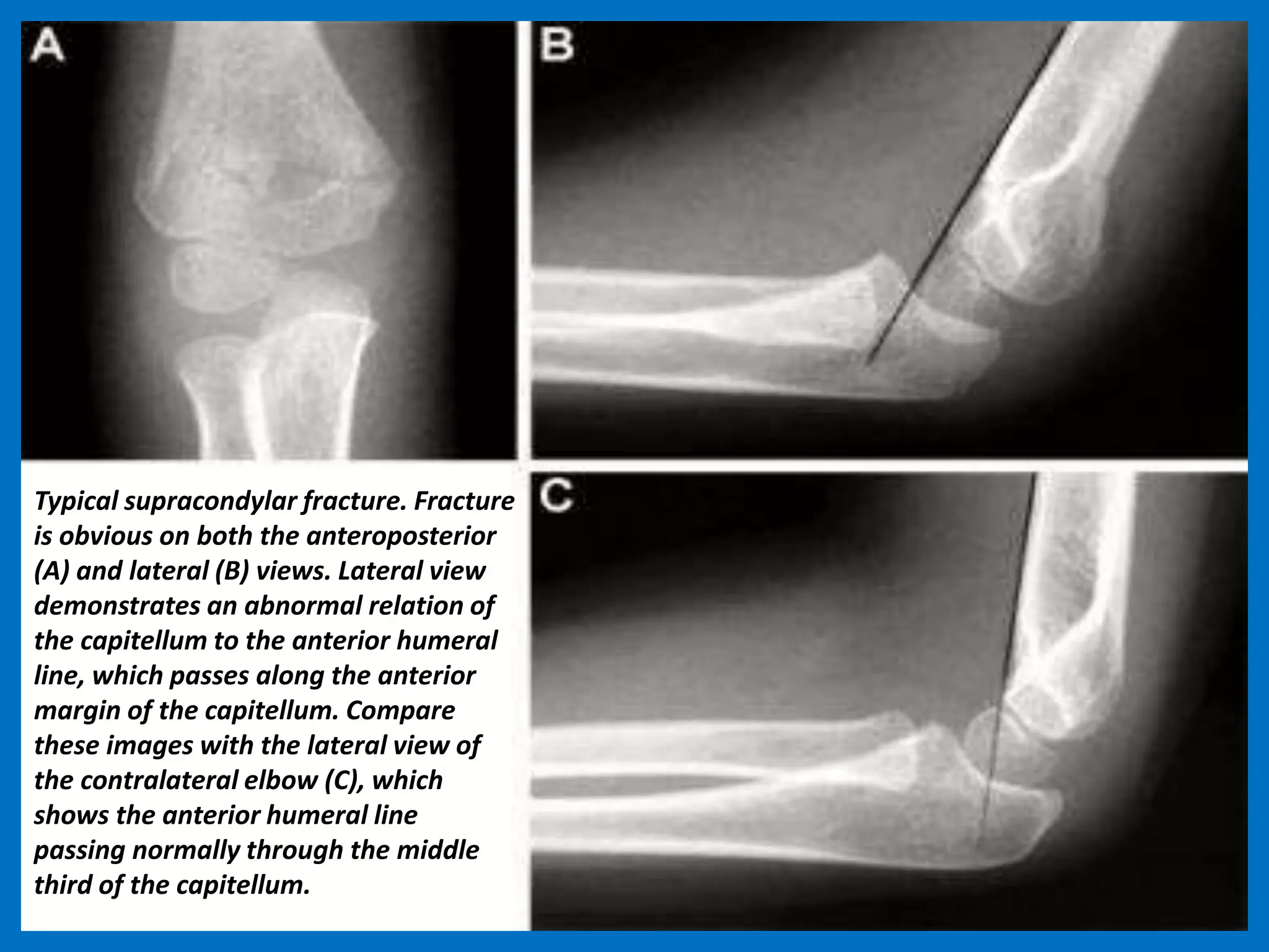 Presentation1.pptx mri of elbow joint | PPTX