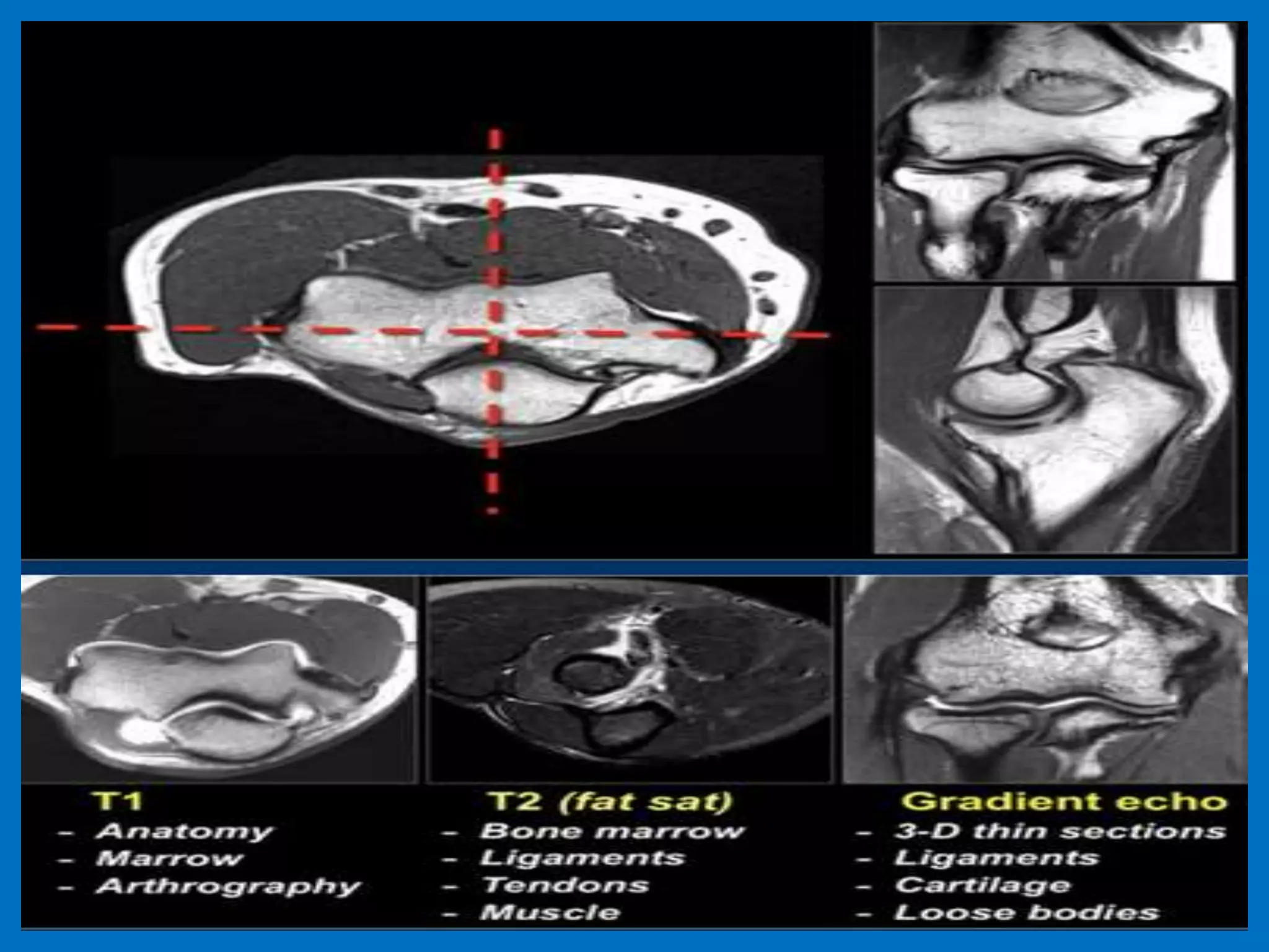 Presentation1.pptx mri of elbow joint | PPTX