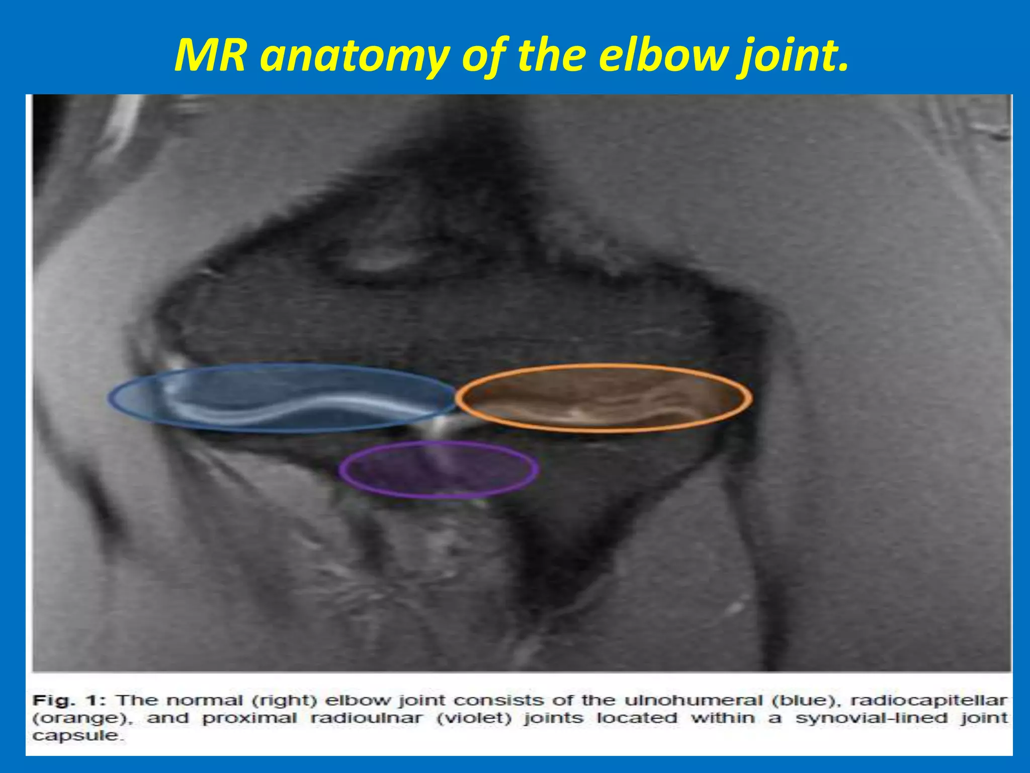 Presentation1.pptx mri of elbow joint | PPTX