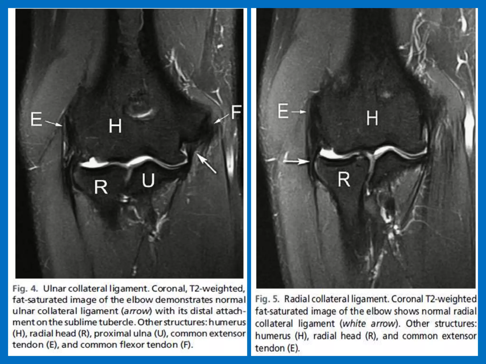 Presentation1.pptx mri of elbow joint | PPTX
