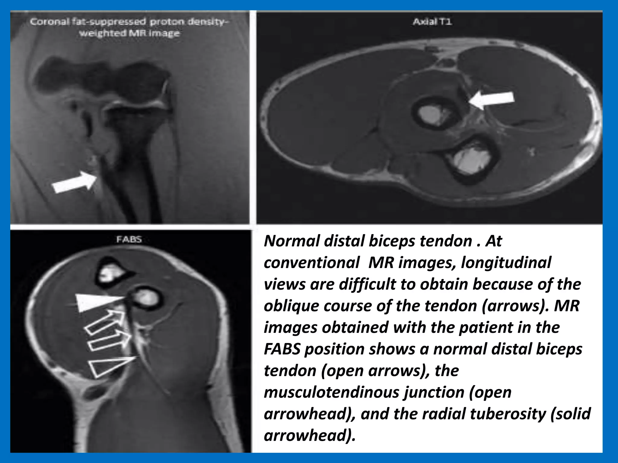Presentation1.pptx mri of elbow joint | PPTX